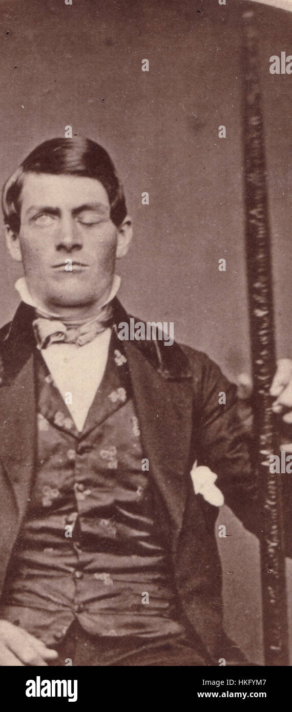 Phineas gage hi-res stock photography and images - Alamy