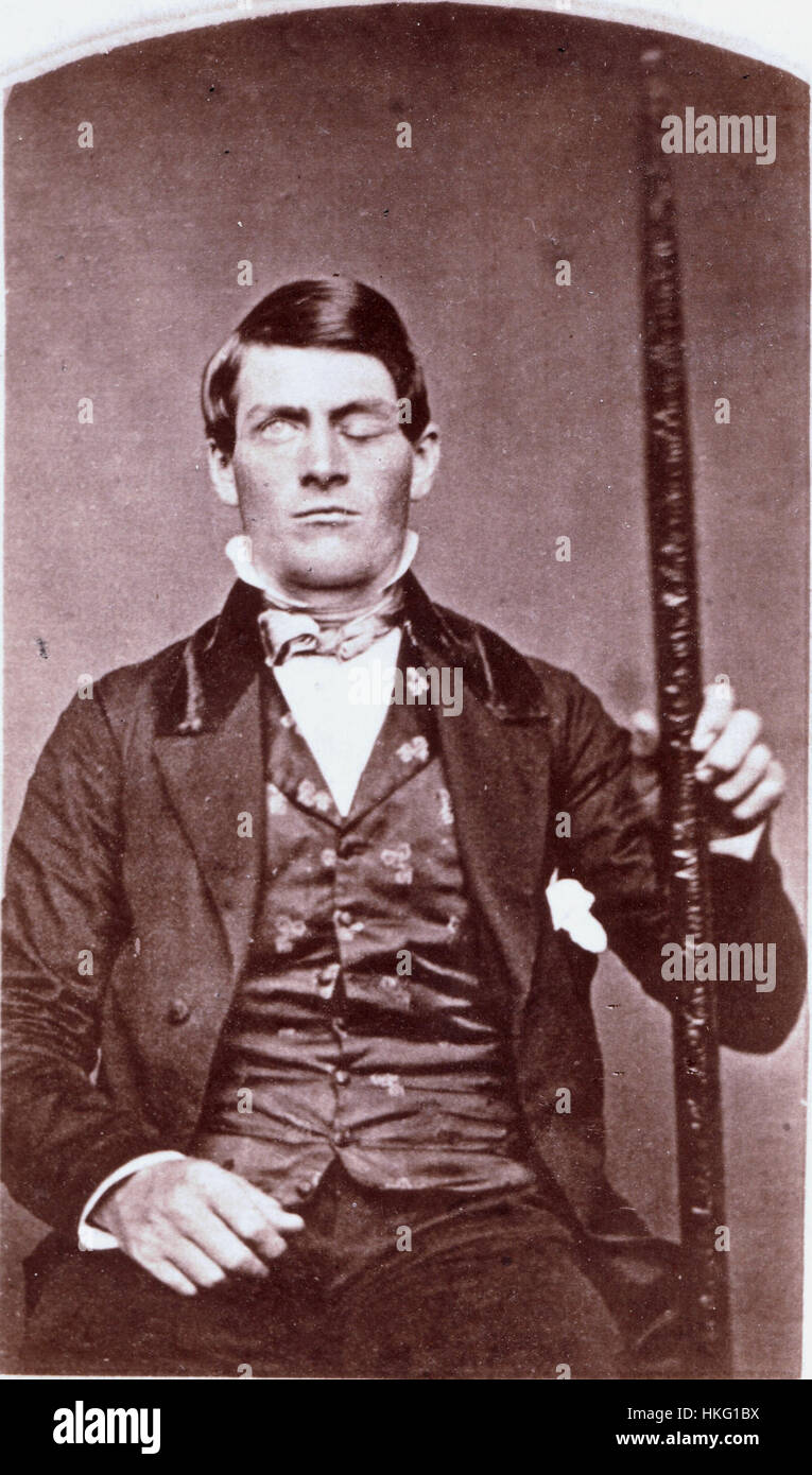 Phineas gage hi-res stock photography and images - Alamy