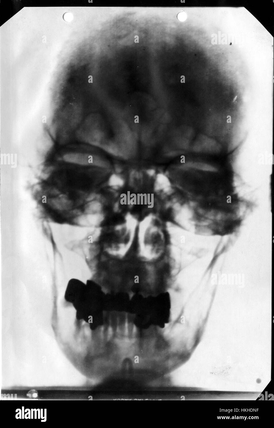 X-ray of the head of Adolf Hitler (1889-1945), 1930. Courtesy National ...