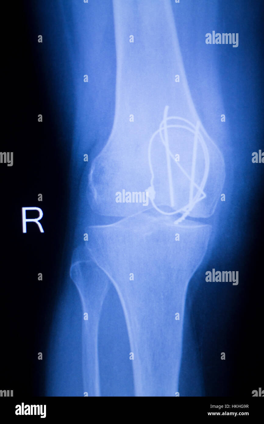 Knee joint implant wire xray showing in medical orthpodedic ...
