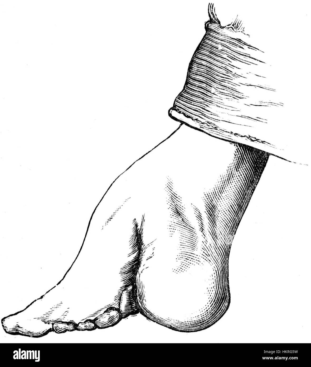 This artwork depicts the interior view of a Chinese woman's foot ...