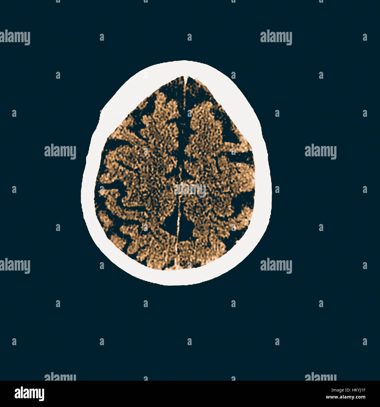 Head CT scan of an 85 year old female patient with signs of dementia ...