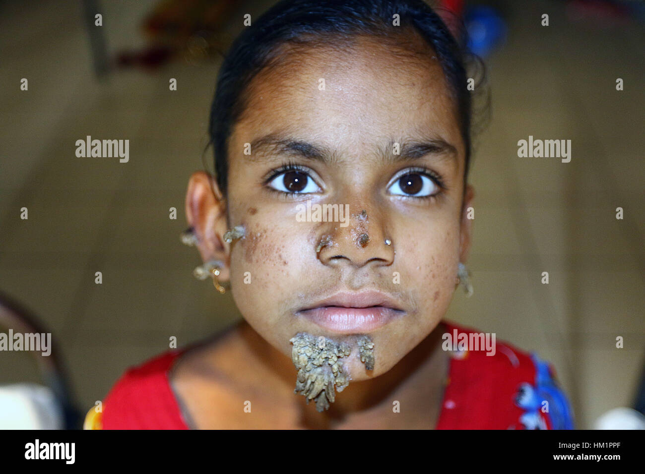 Dhaka Bangladesh 01 Feb 2017 Bangladeshi Patient Sahana Khatun 10