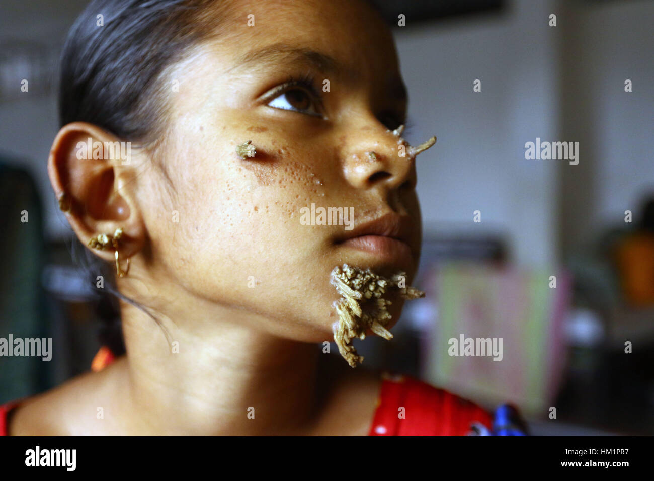 Dhaka Bangladesh 01 Feb 2017 Bangladeshi Patient Sahana Khatun 10