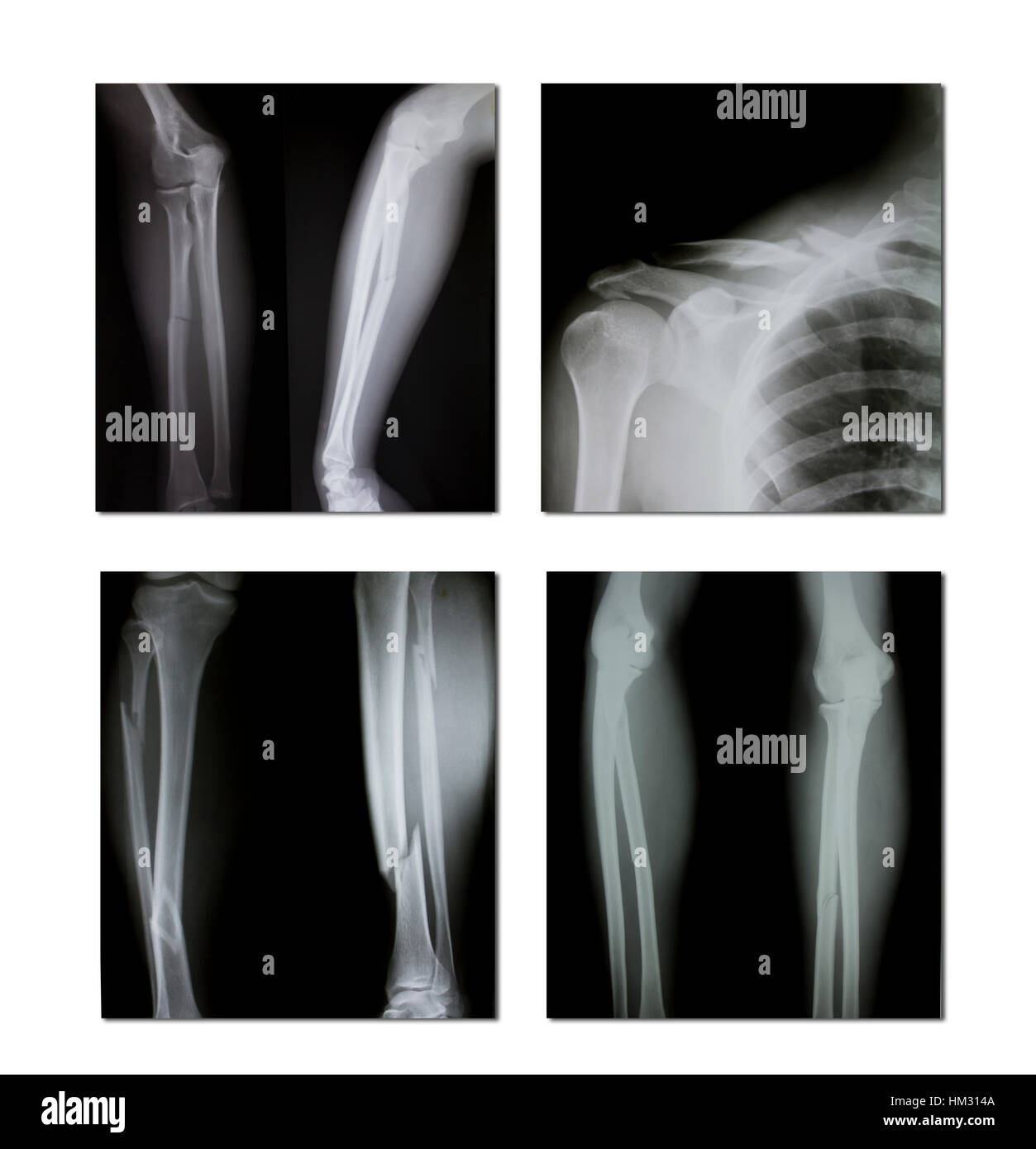 Broken legs Cut Out Stock Images & Pictures - Alamy