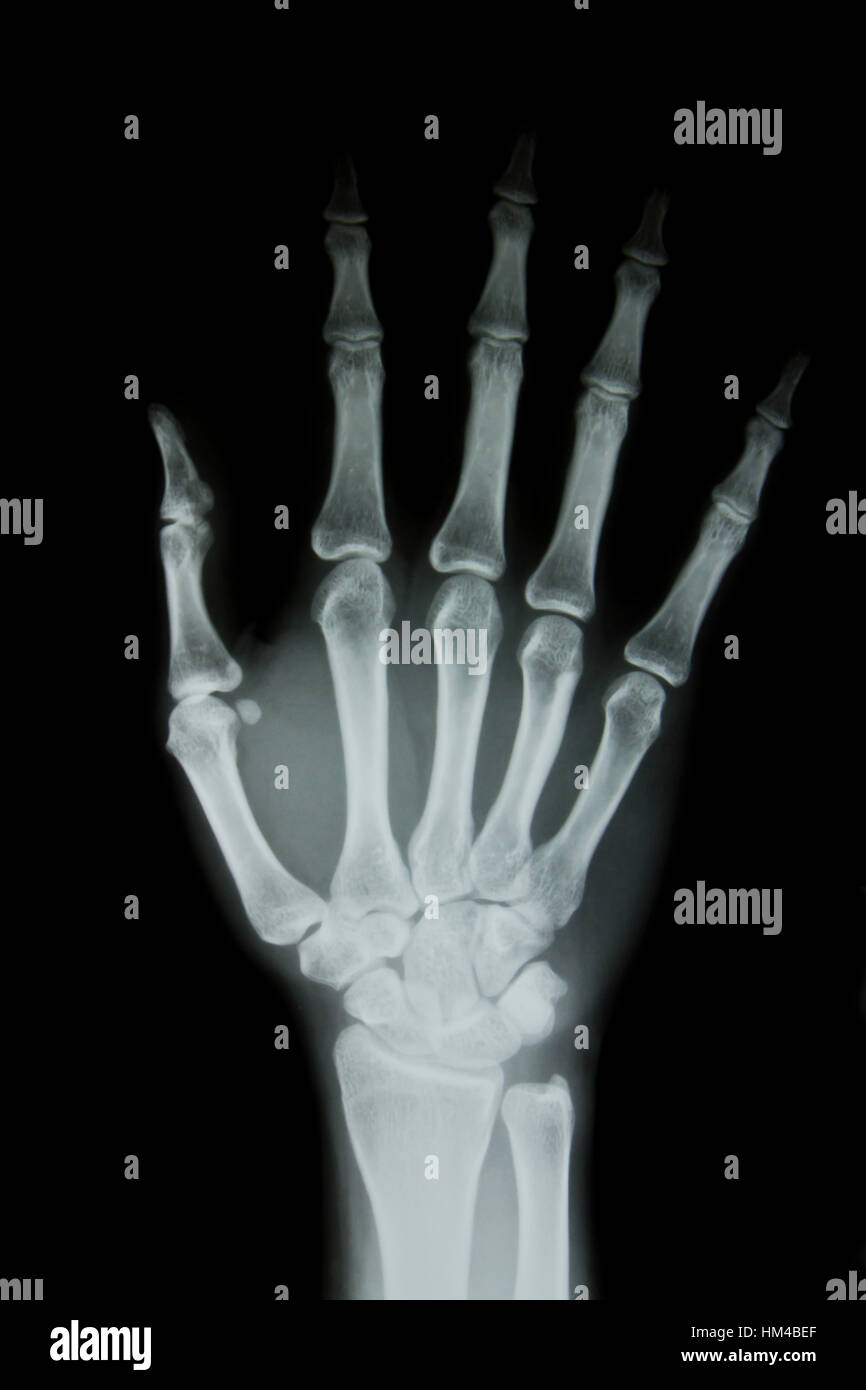 Broken Finger Tip X Ray Hand Fractures OrthoInfo AAOS
