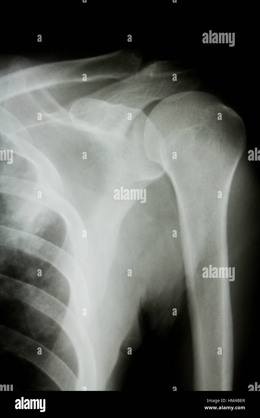 X-ray of human shoulder Stock Photo - Alamy