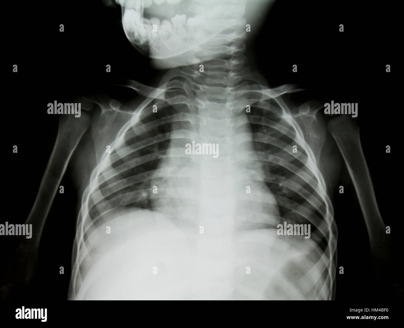 Chest x-ray of young boy Stock Photo - Alamy