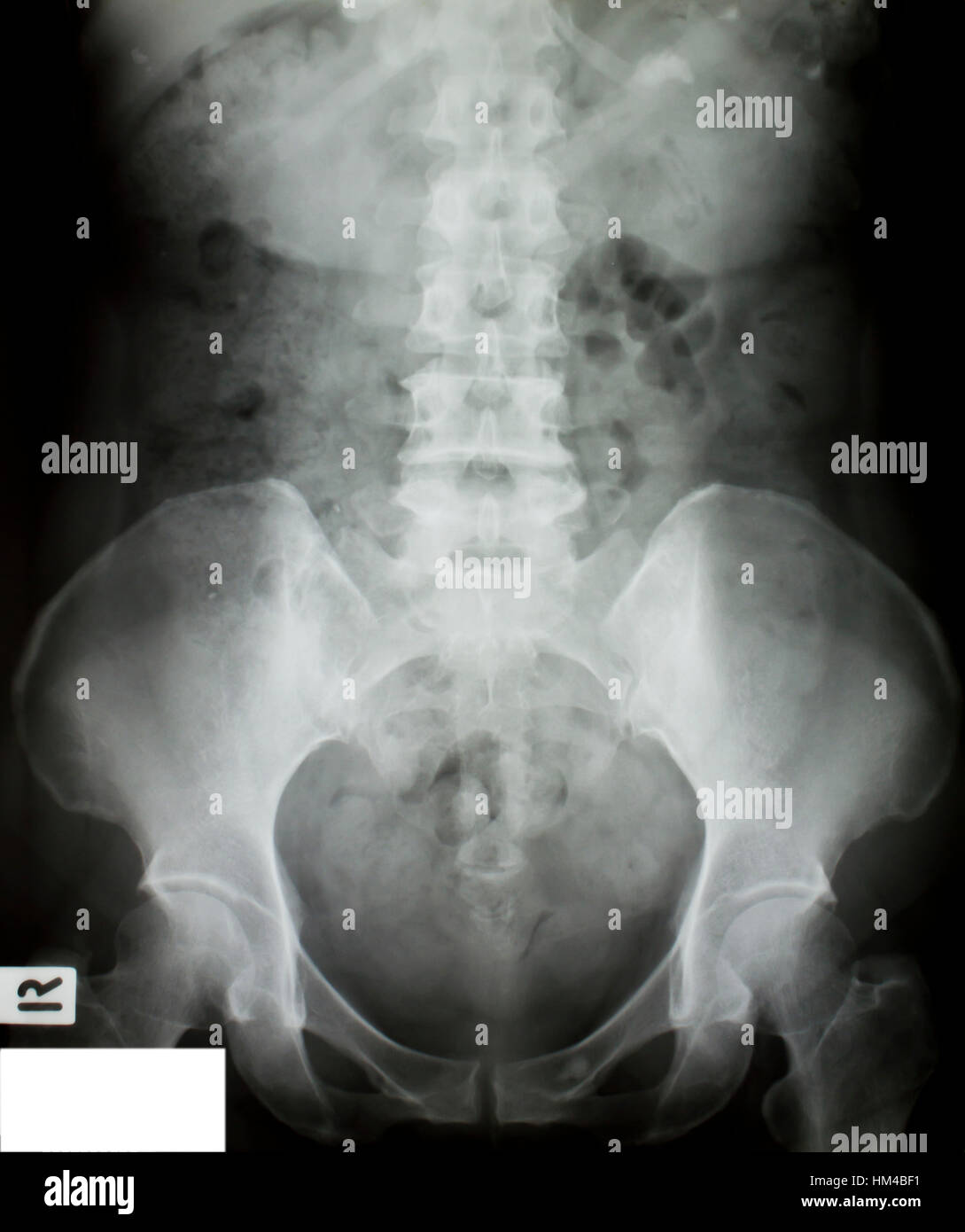 X-ray of the pelvis and spinal column Stock Photo - Alamy