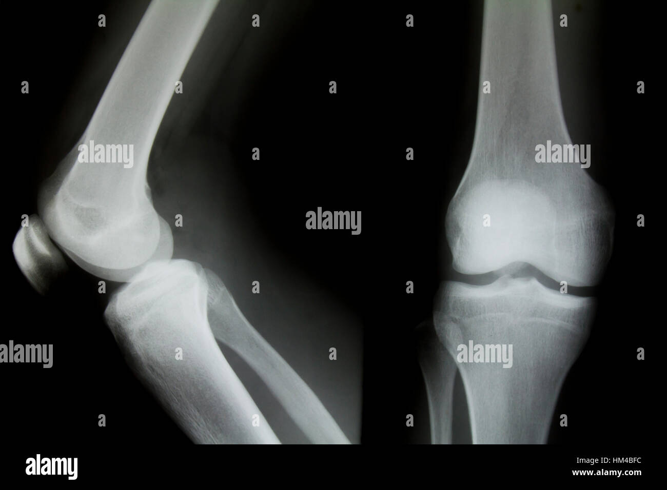 X-ray of both human knee Stock Photo - Alamy