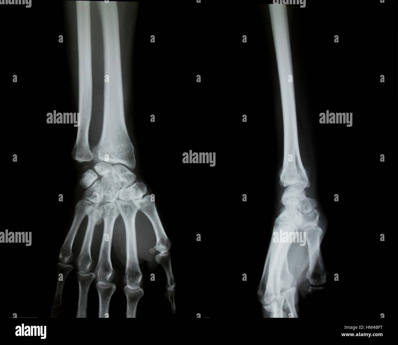 X-ray of both human arms and hands Stock Photo - Alamy