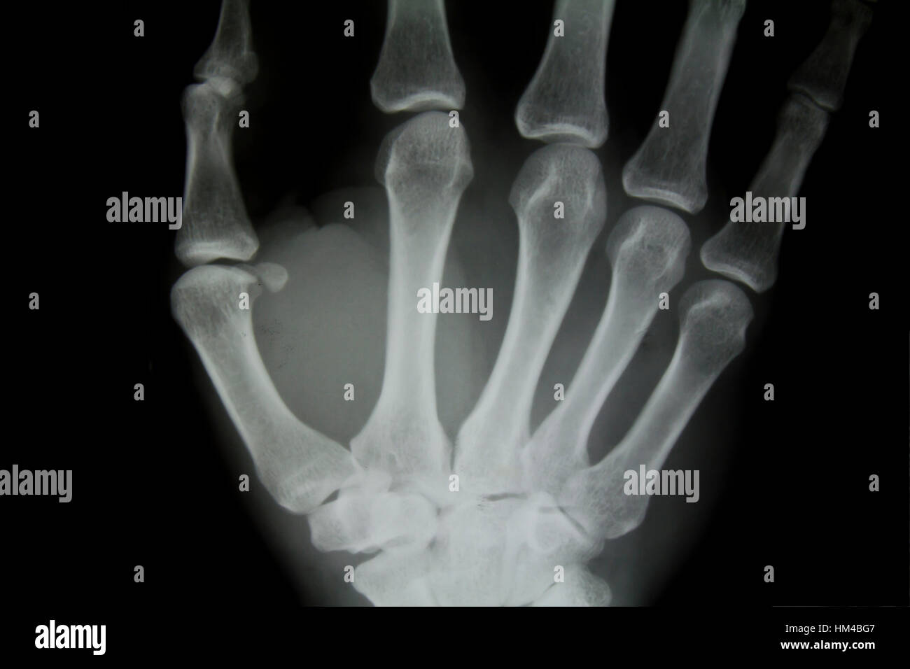 X-ray of human hand Stock Photo - Alamy