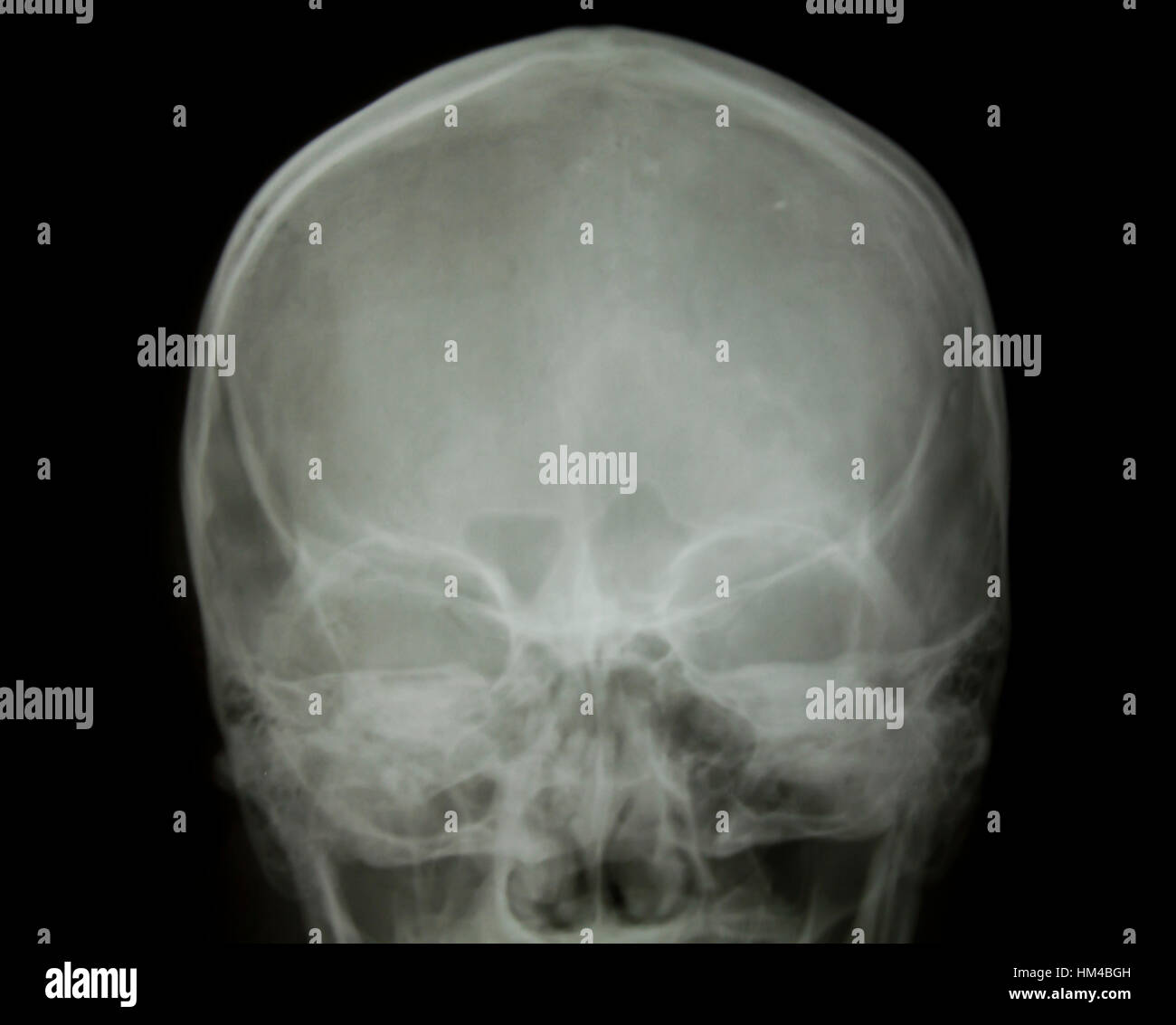 Front face skull x-ray image Stock Photo - Alamy