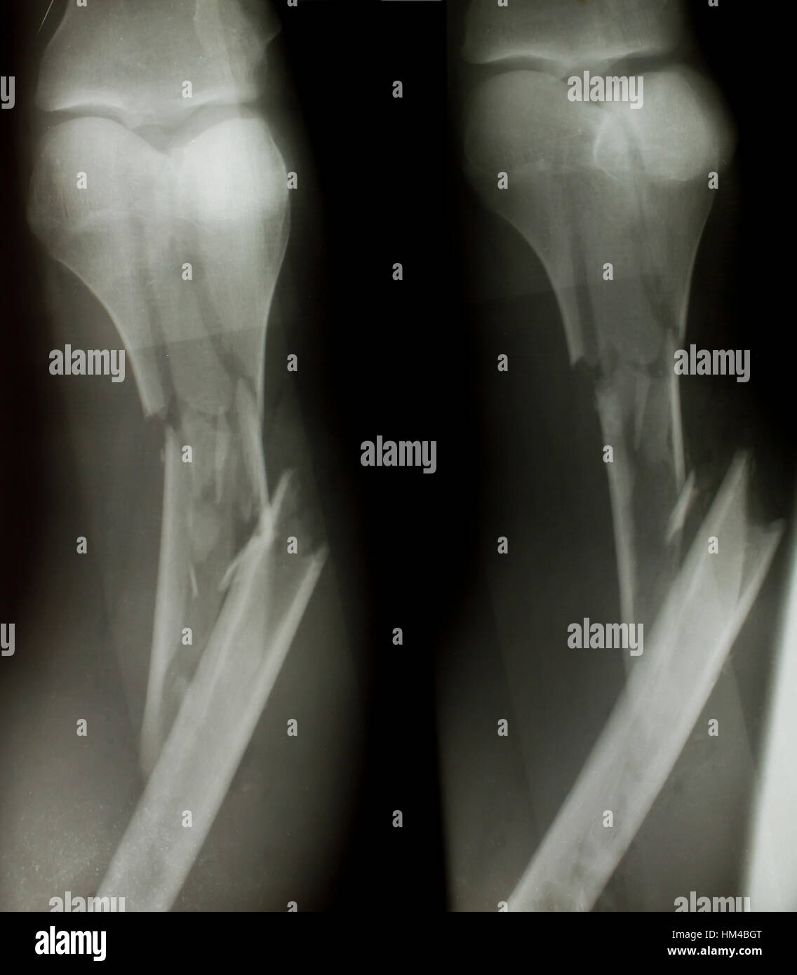 X-ray of both human legs (fractures Stock Photo - Alamy