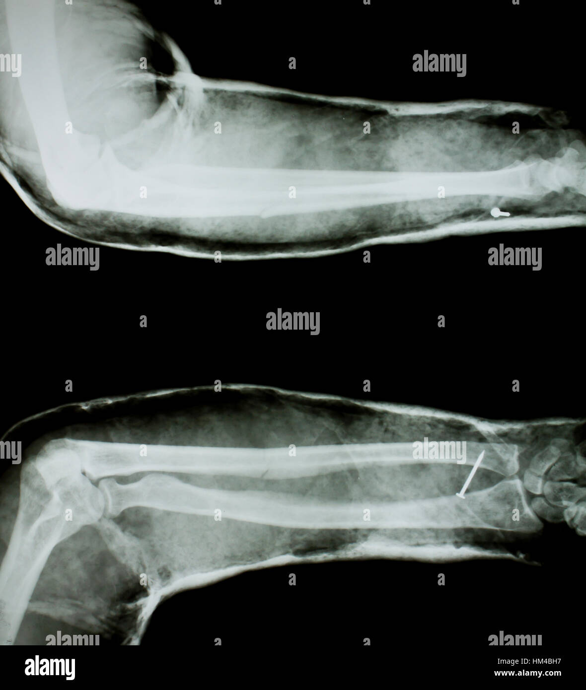 X-ray of human arm with arm splint Stock Photo - Alamy