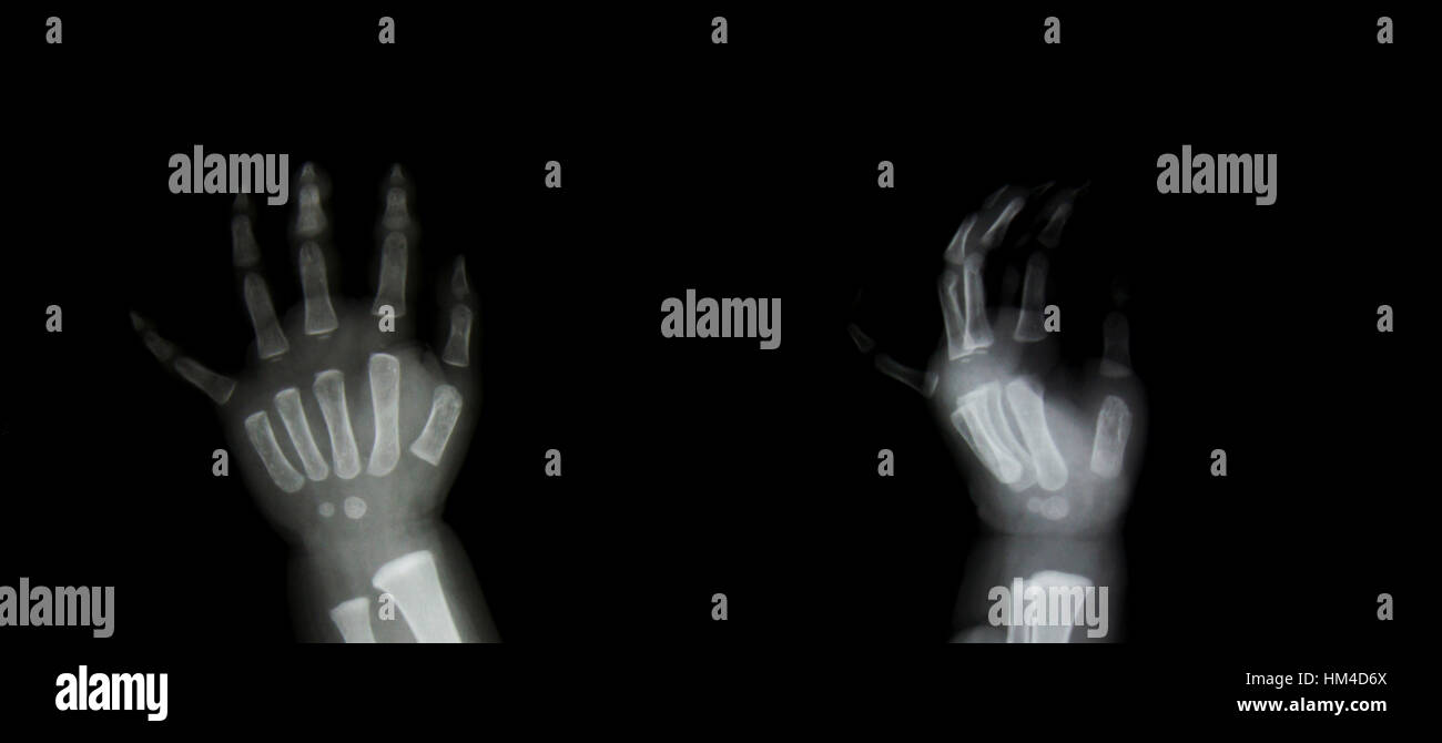 X-ray of both human hands Stock Photo - Alamy