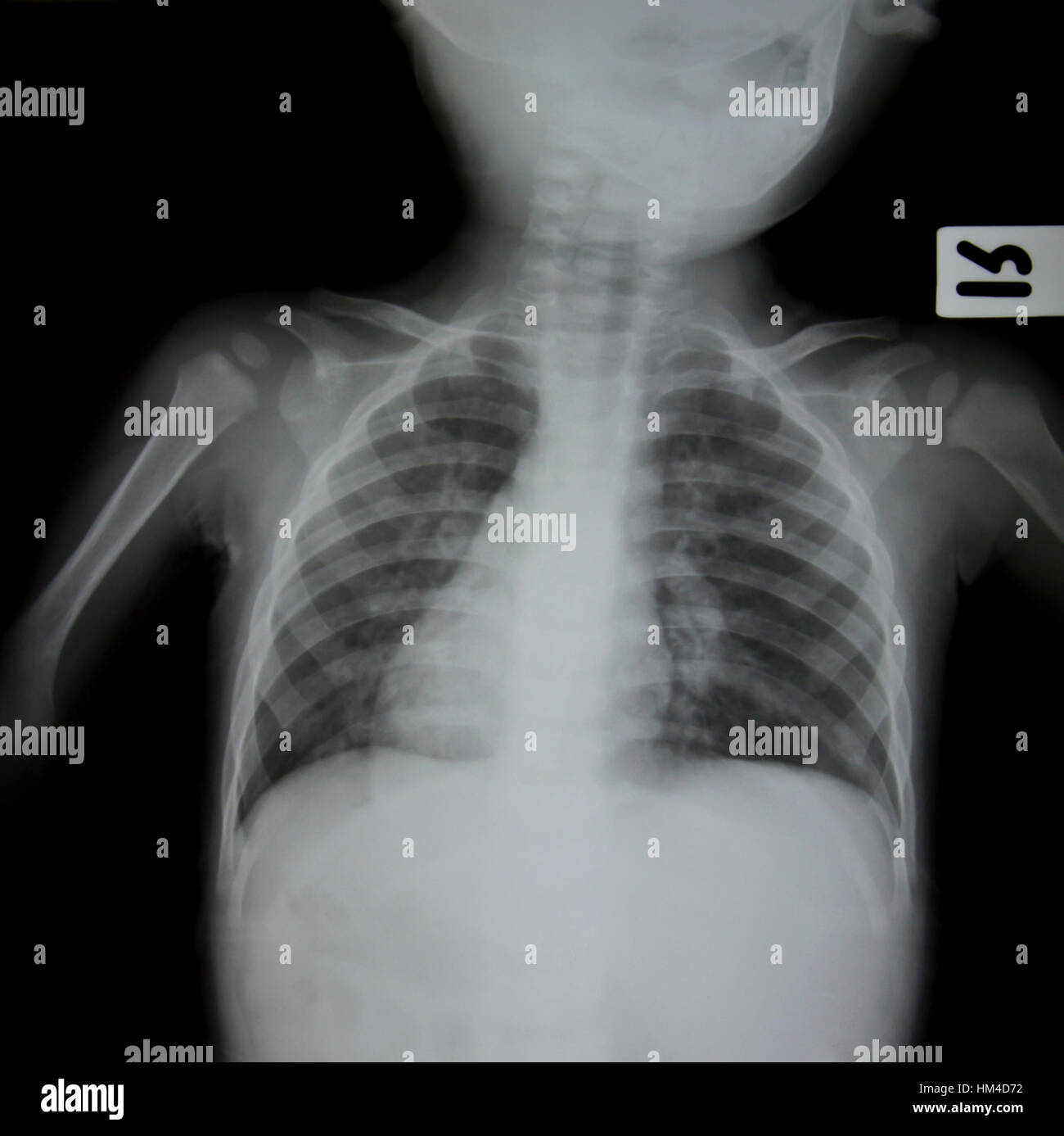 Chest x-ray of young boy Stock Photo - Alamy