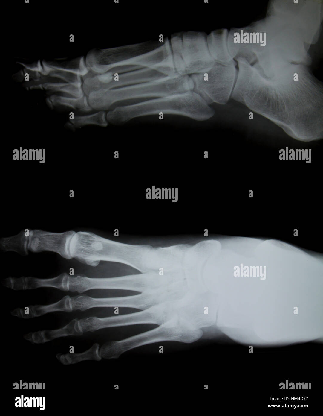 X-ray of both human feet Stock Photo - Alamy