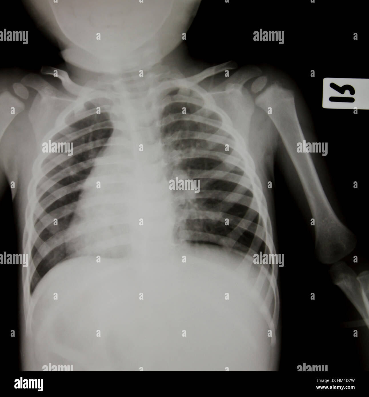 Chest X Ray Children High Resolution Stock Photography and Images - Alamy