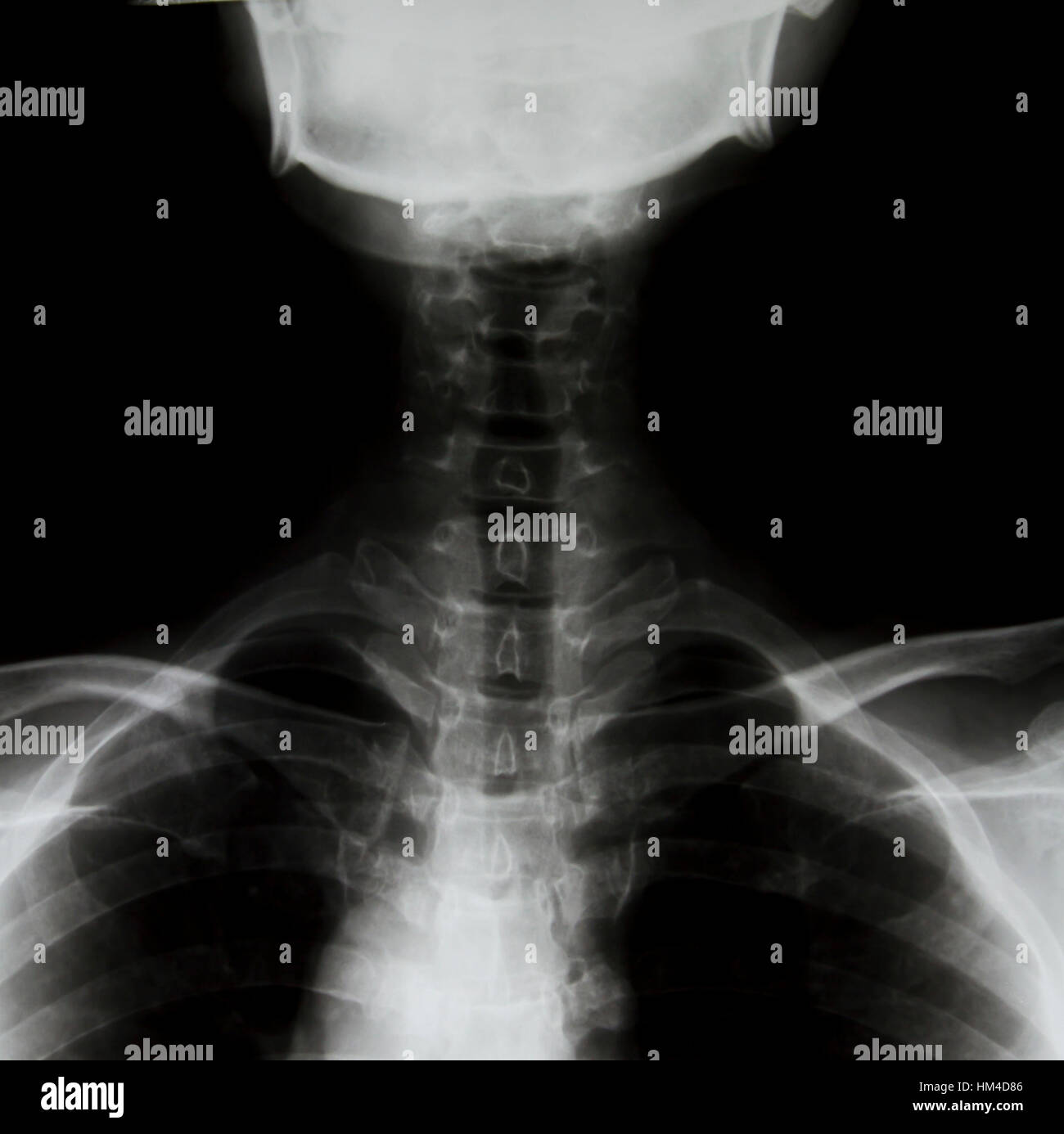 Detail of neck x-ray image Stock Photo - Alamy