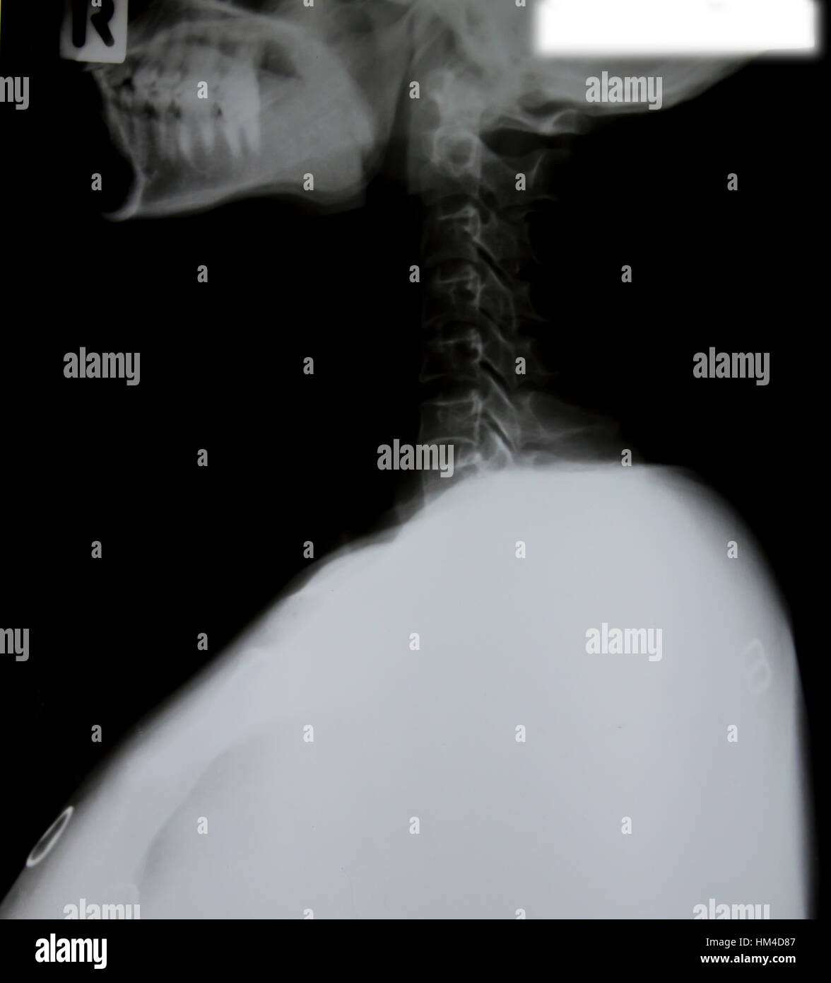 Detail of neck x-ray image Stock Photo - Alamy