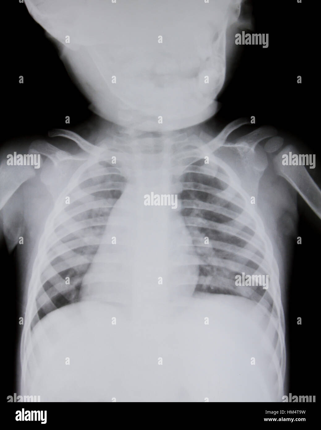 Chest x-ray of young boy Stock Photo - Alamy