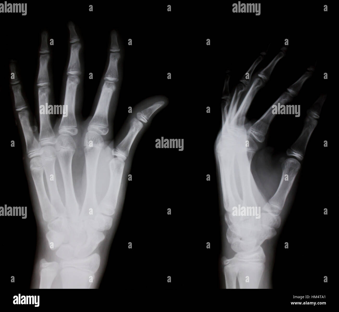 X-ray of both human hands Stock Photo - Alamy