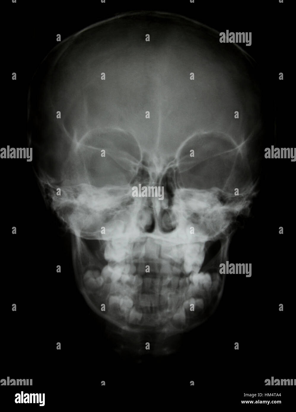 Skull X Ray Front