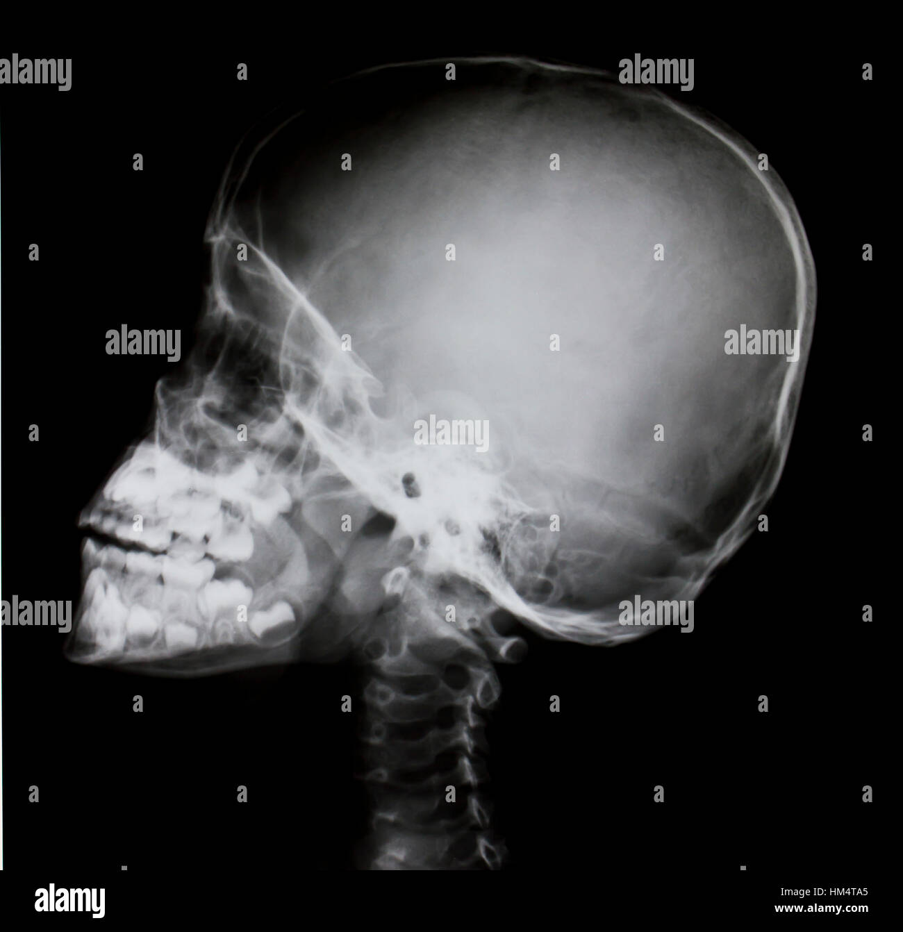 detail of neck and head x-ray image Stock Photo - Alamy
