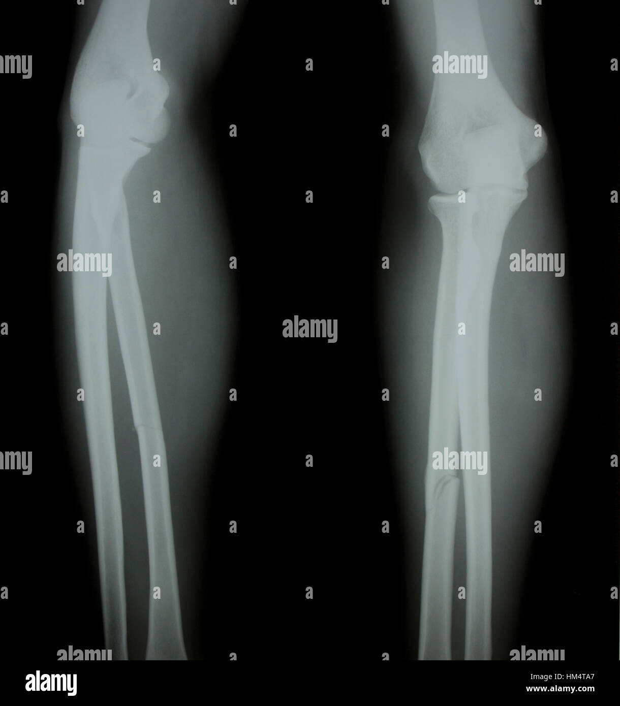 X-ray of both human legs (broken legs Stock Photo - Alamy