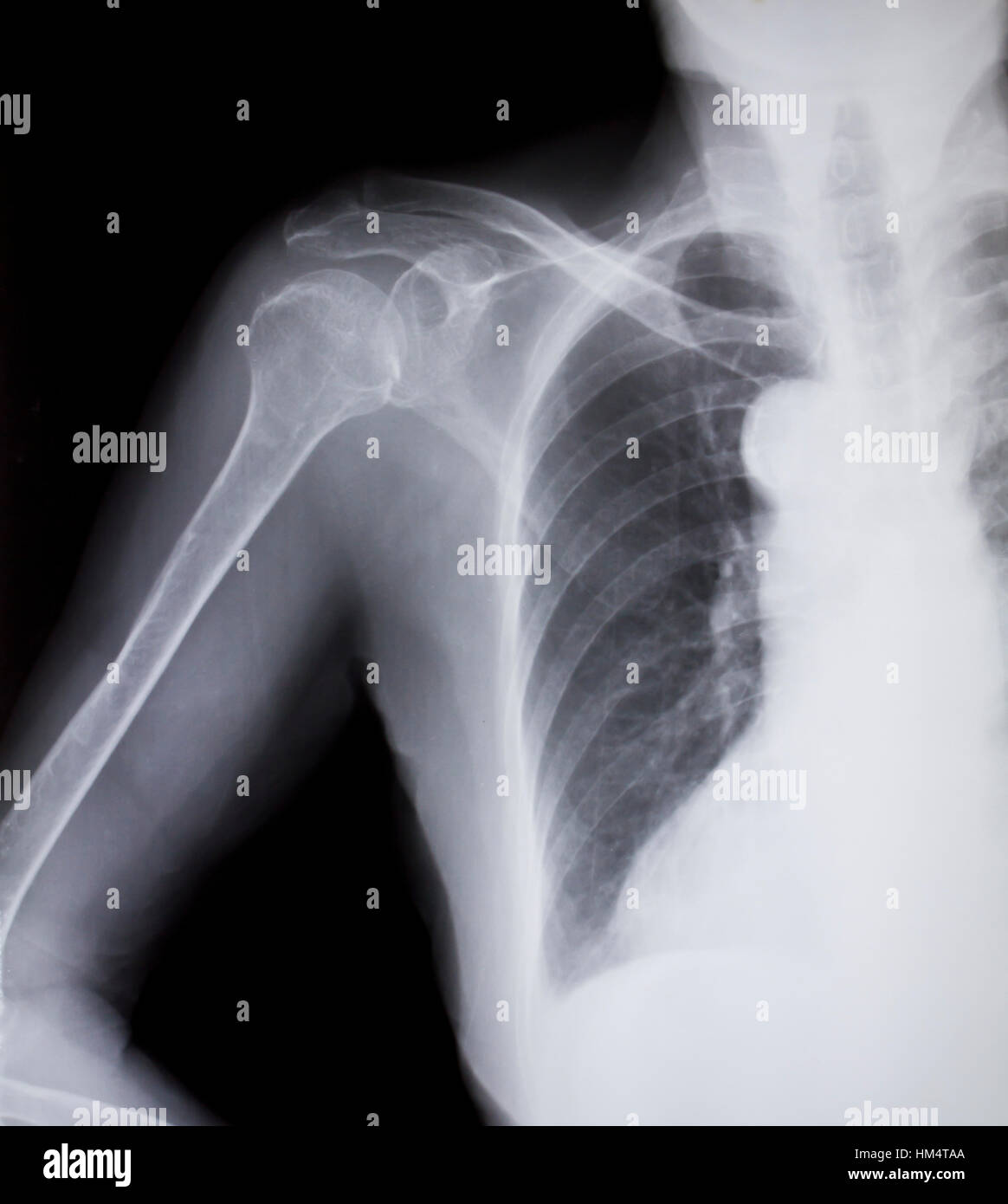 X-ray of human shoulder (broken shoulder Stock Photo - Alamy