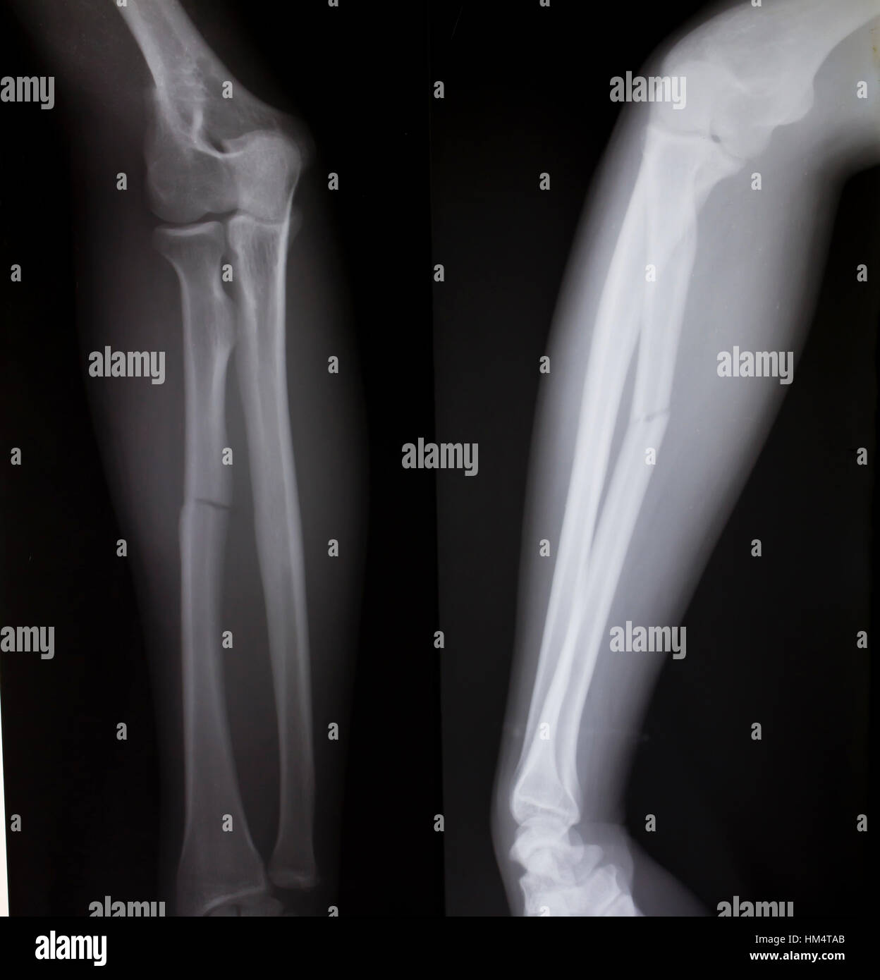 X-ray of both human arms (broken arm Stock Photo - Alamy