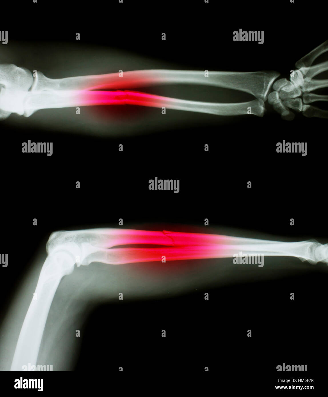 X-ray of both human arms Stock Photo - Alamy