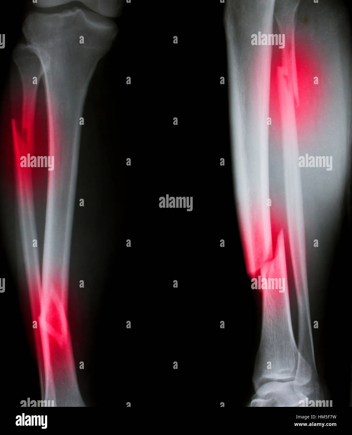 X-ray of both human legs (broken legs Stock Photo - Alamy