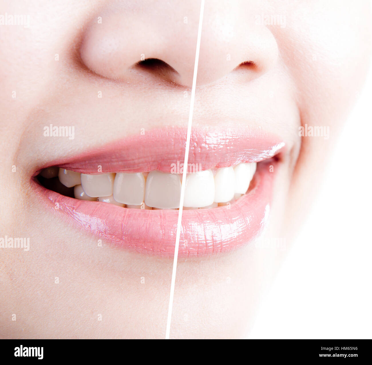 woman teeth before and after whitening. Over white background Stock ...