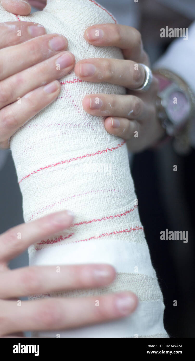 Doctor applying a plaster cast and bandages to patient forearm and ...