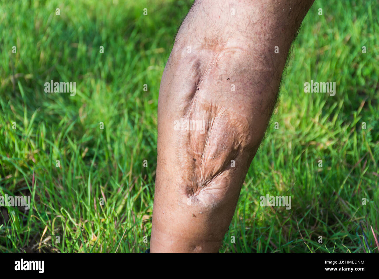 Old scar of leg injury, from car or motorbike accident, deep tissue ...