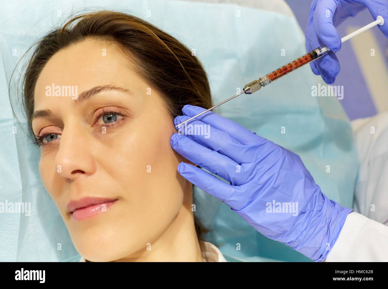 Lipofilling. Fat Grafting. Liposculpture. Lipofilling is based on ...