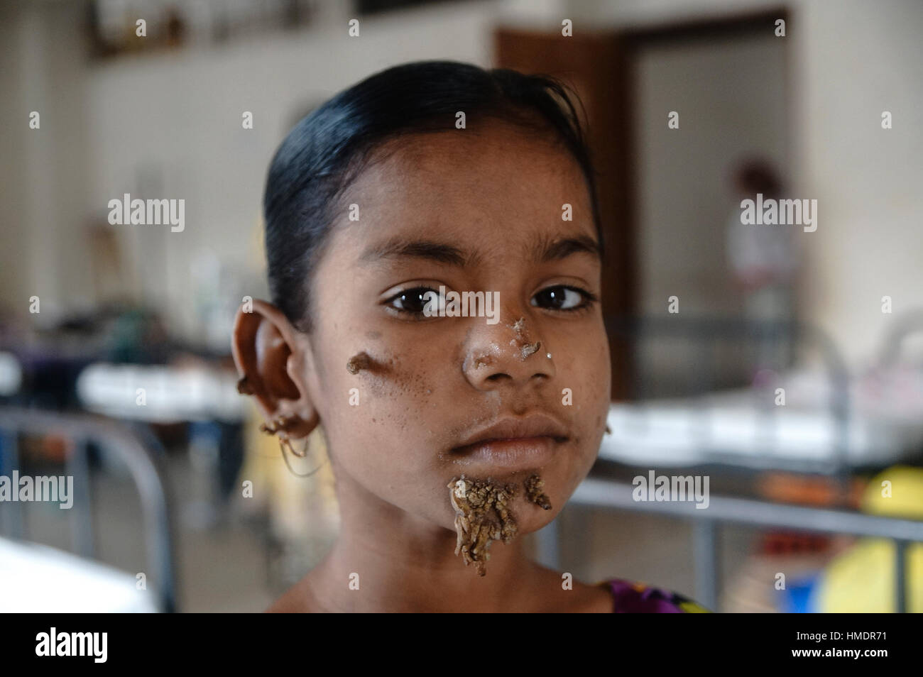 A Bangladeshi Girl Shanaj 10 Poses For A Photo At Dhaka Medical