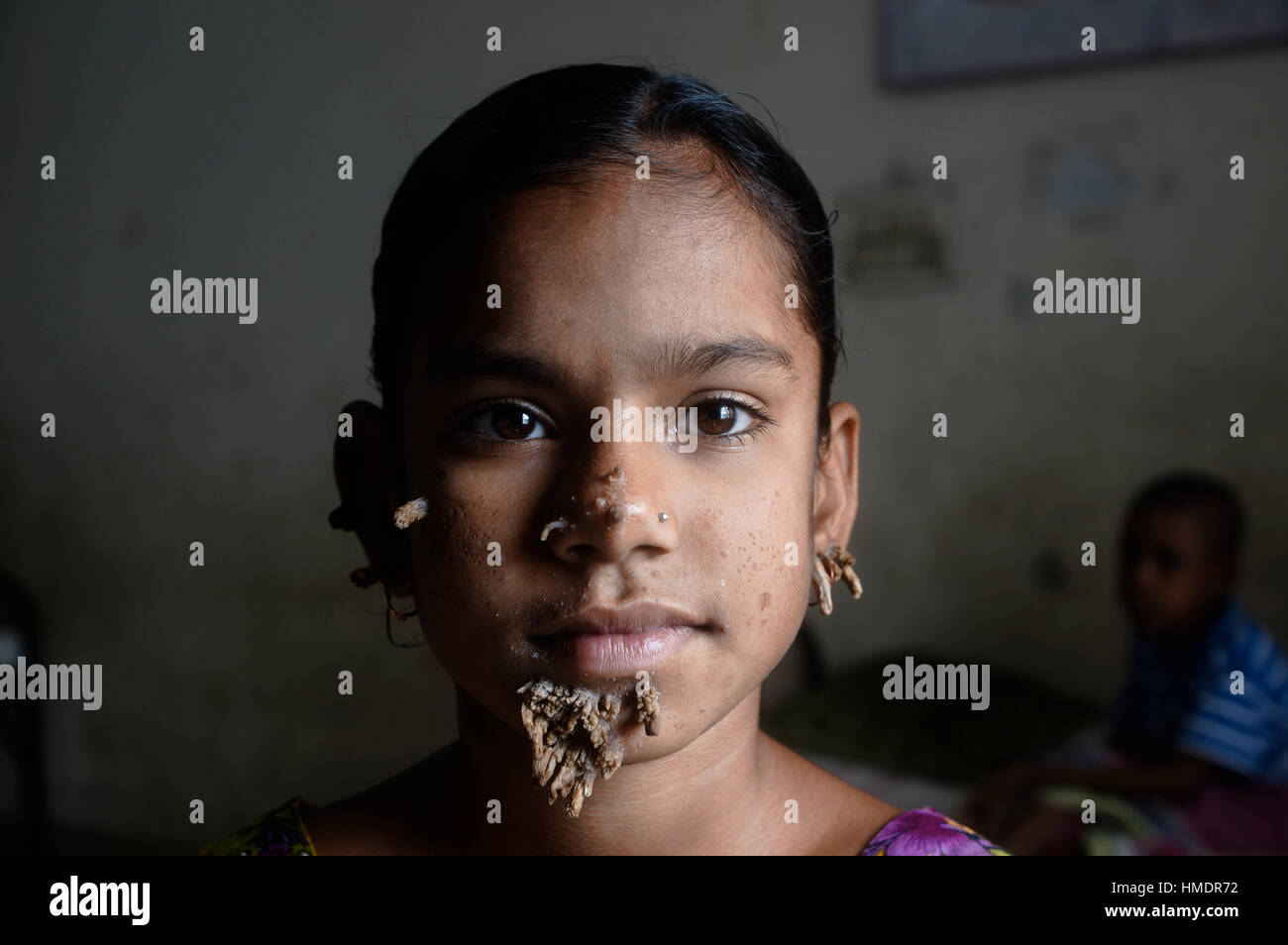 A Bangladeshi Girl Shanaj 10 Poses For A Photo At Dhaka Medical