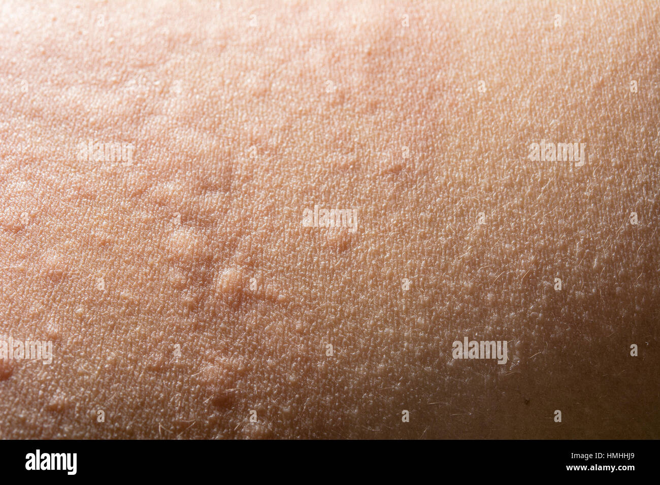 Urticaria Stock Photos & Urticaria Stock Images - Alamy