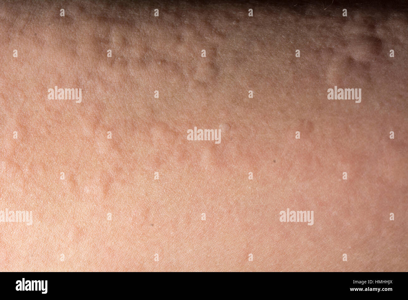Close up of urticaria or allergy rash Stock Photo - Alamy