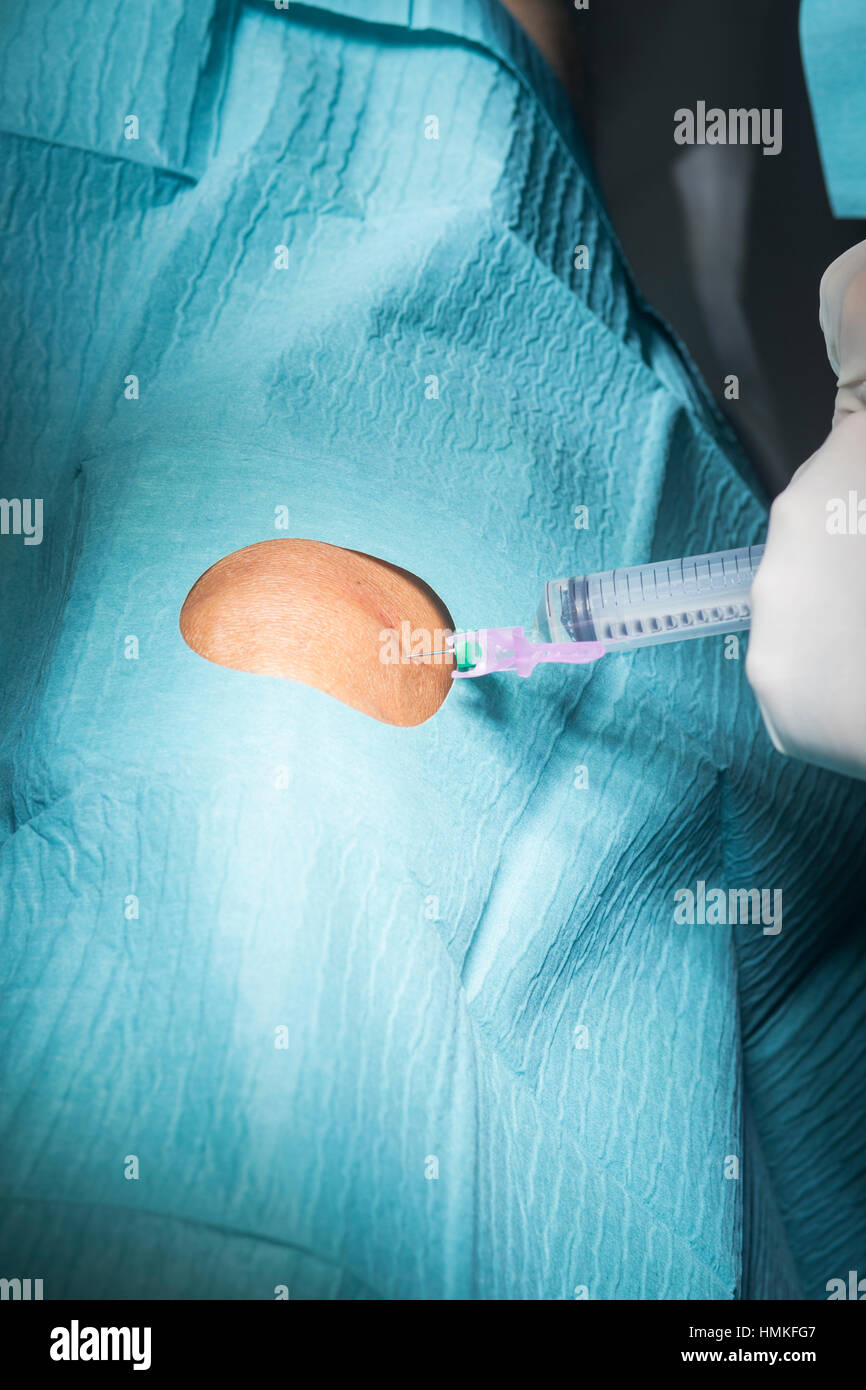 Anaesthtist anaesthetic injection in knee for surgery hospital ...