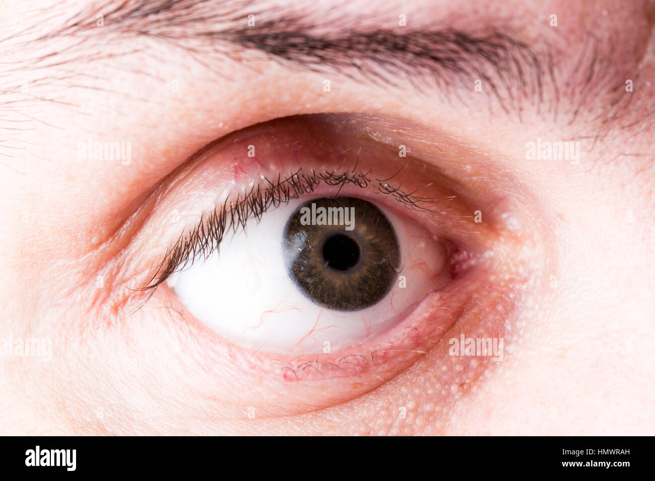 ocular prosthesis in men after the injury and loss of the eye Stock ...