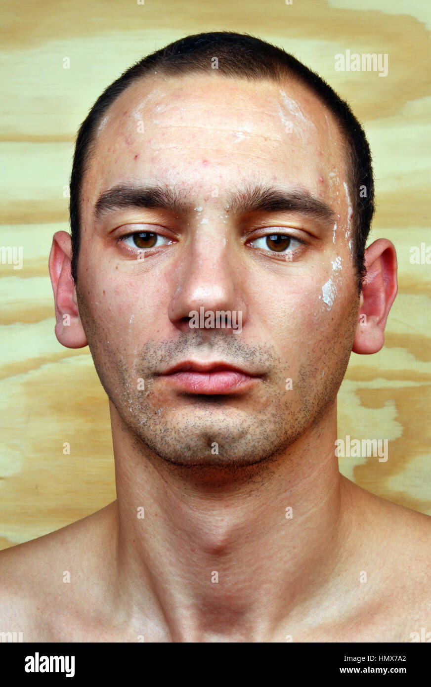 Young man with a chronic infection of the skin on the face Stock Photo ...