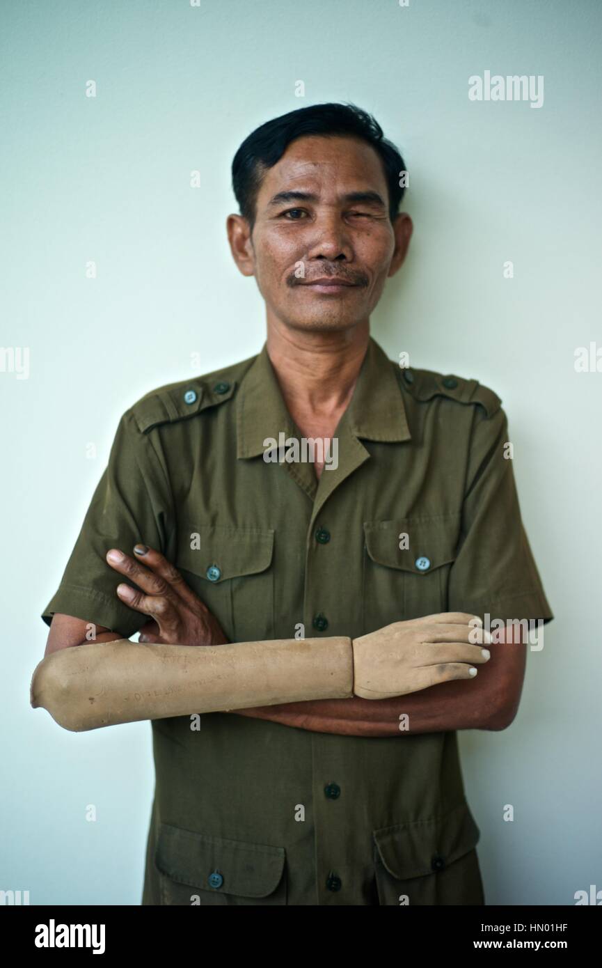 Missing limb man hi-res stock photography and images - Alamy