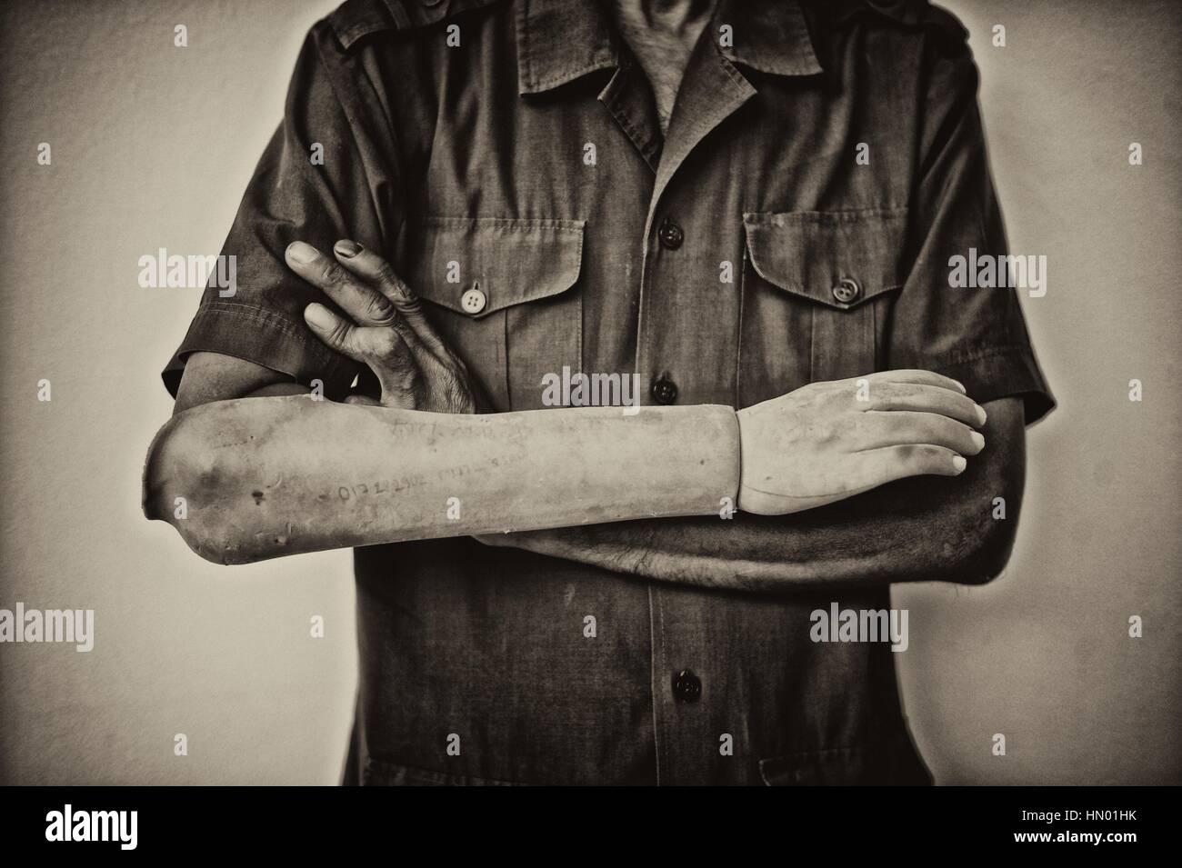 Model released portrait of a Cambodian land mine survivor, who lost one ...