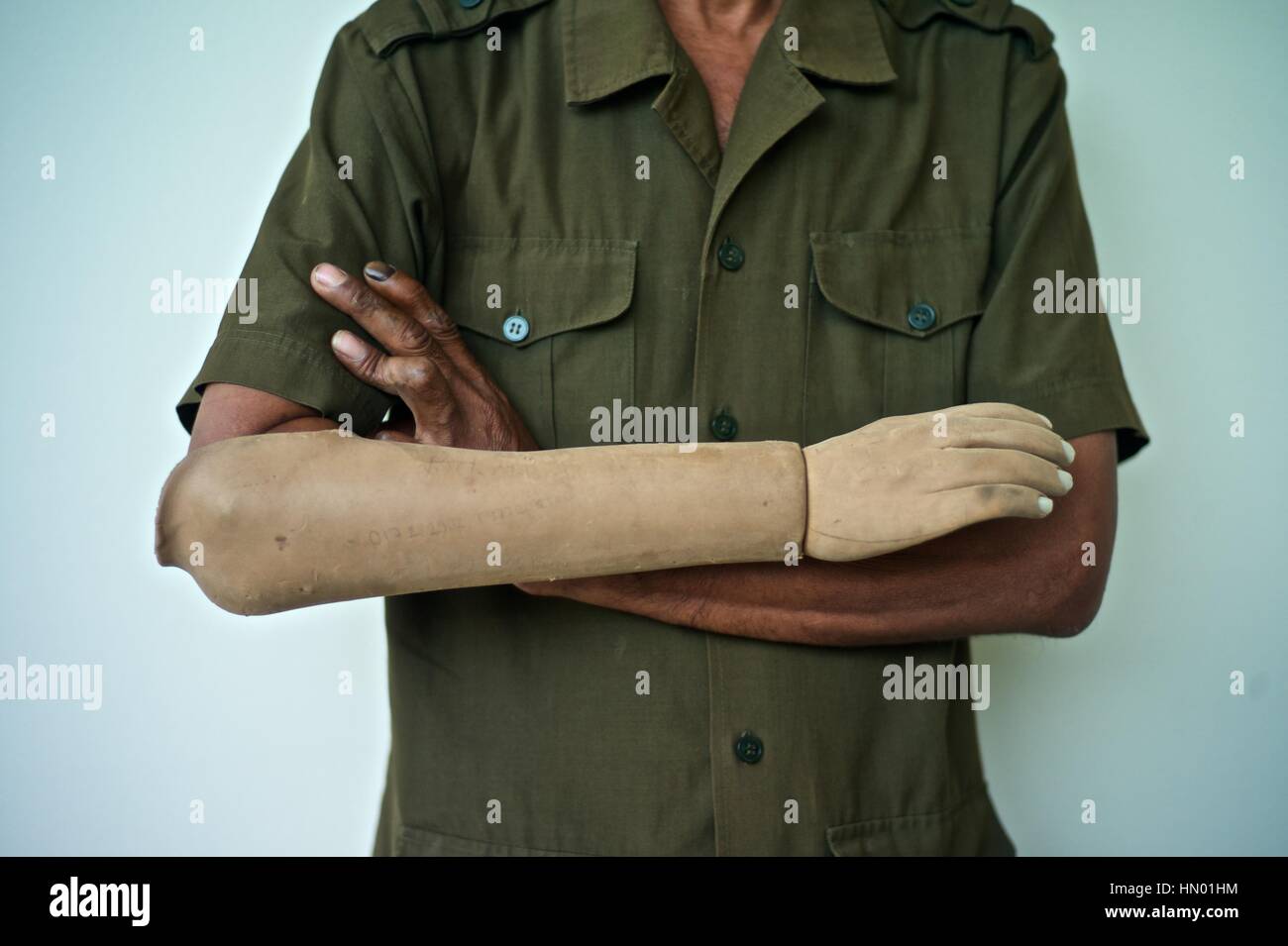 Model released portrait of a Cambodian land mine survivor, who lost one ...
