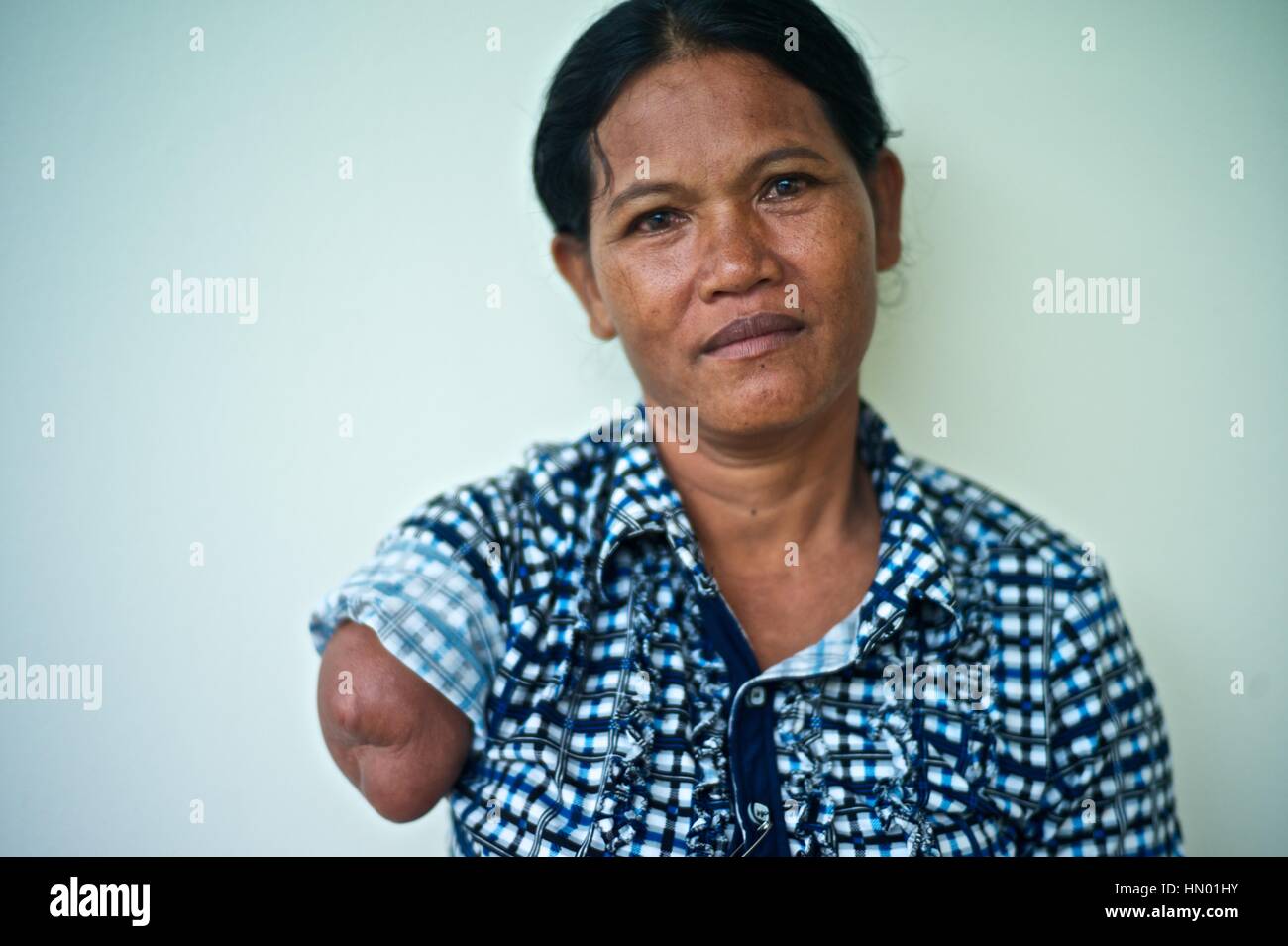 Model released portrait of a Cambodian land mine survivor, who lost an ...