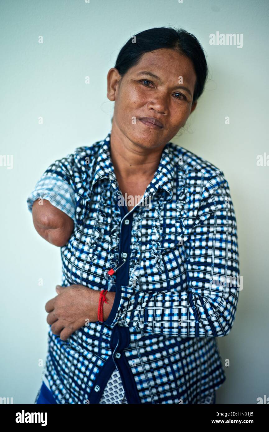Model released portrait of a Cambodian land mine survivor, who lost an ...